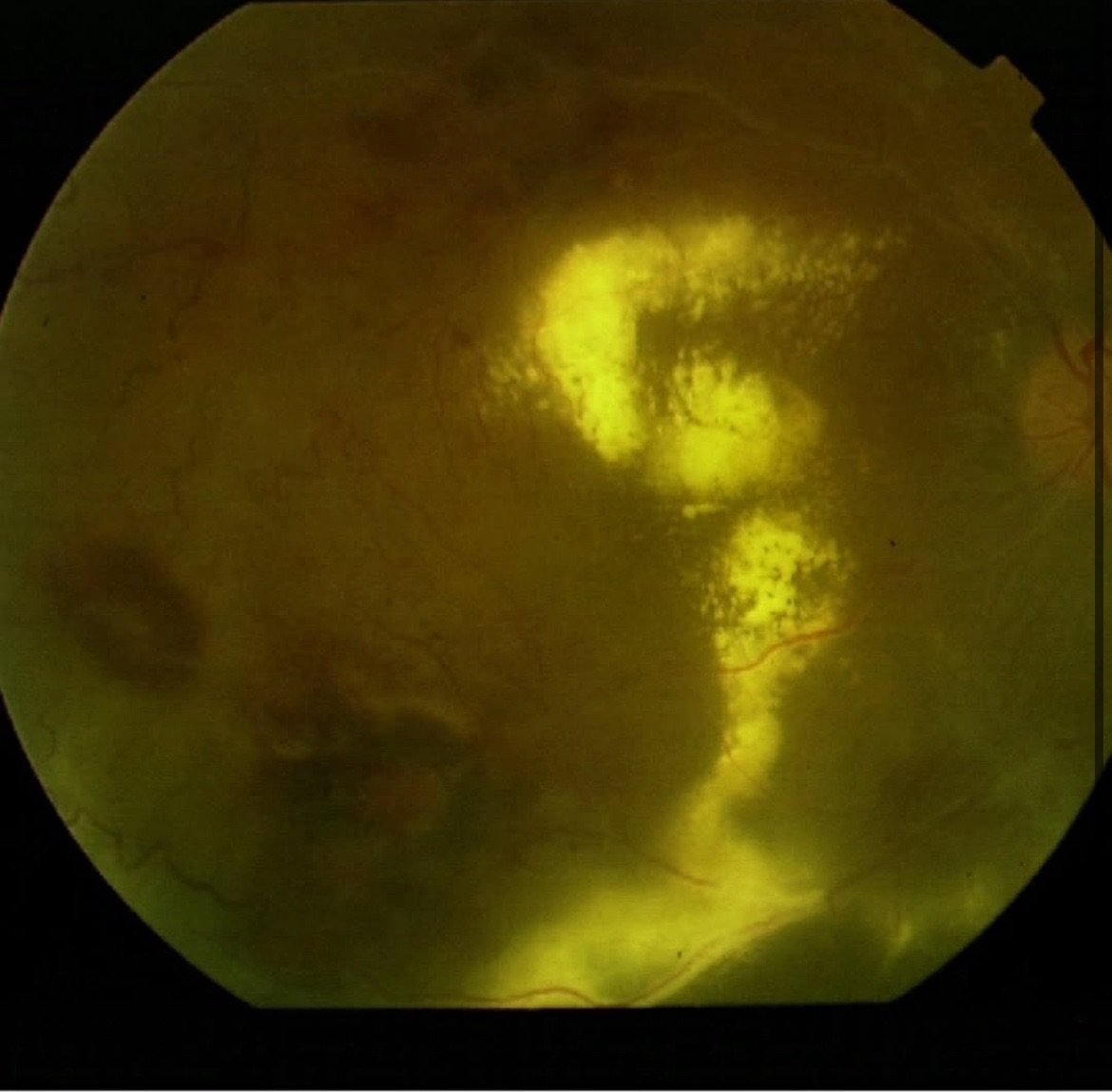 Eales Disease: A Rare Retinal Disorder with Sight-Threatening ...