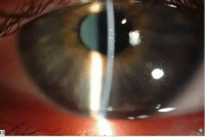 What Is Punctate Keratitis? A Simple Guide for Patients and Eye Care ...