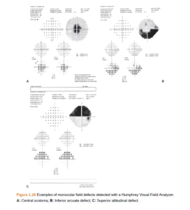 Notes on Interpreting Visual Fields through Humphrey Visual Field ...