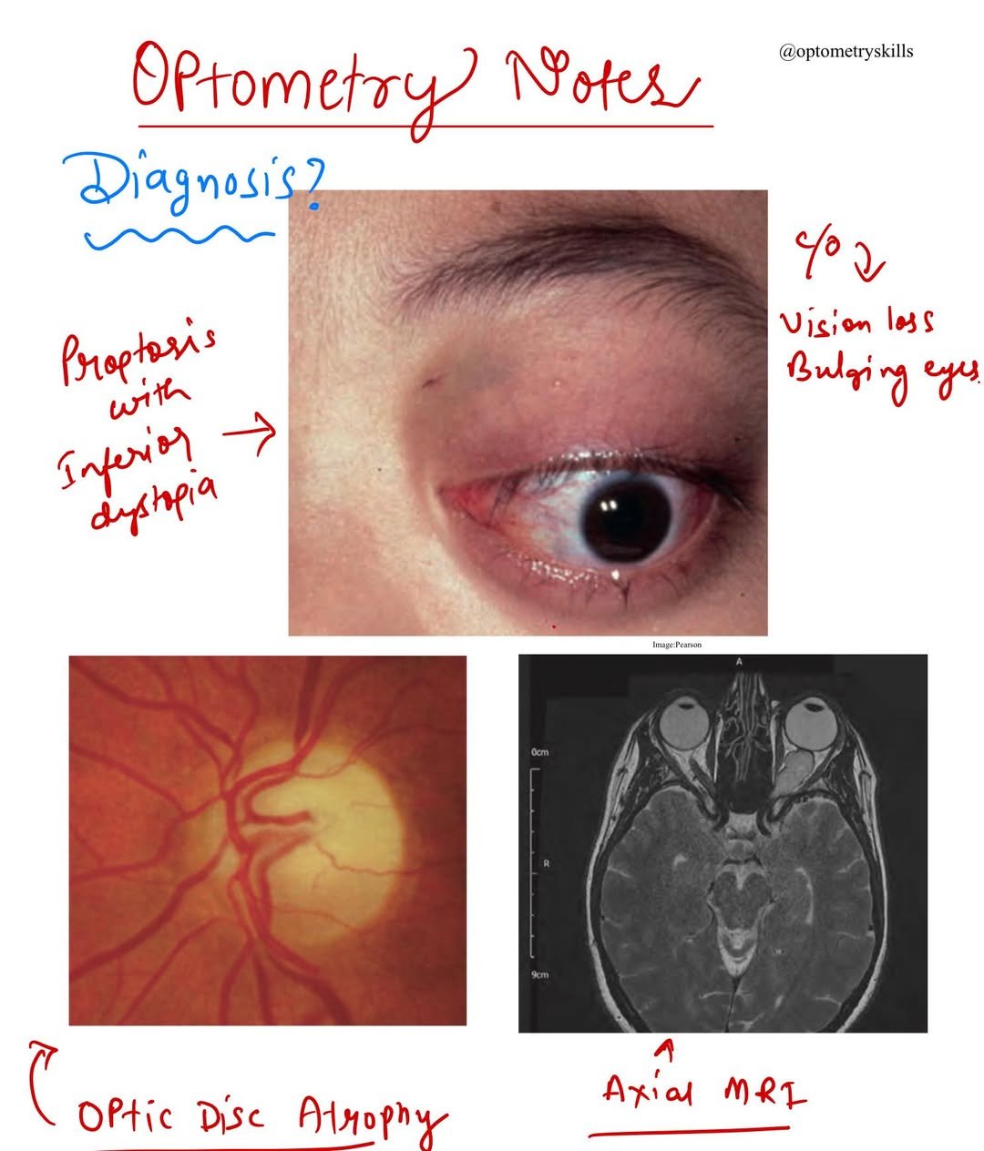 Case Study- Identifying Optic Nerve Glioma - Optometryskills