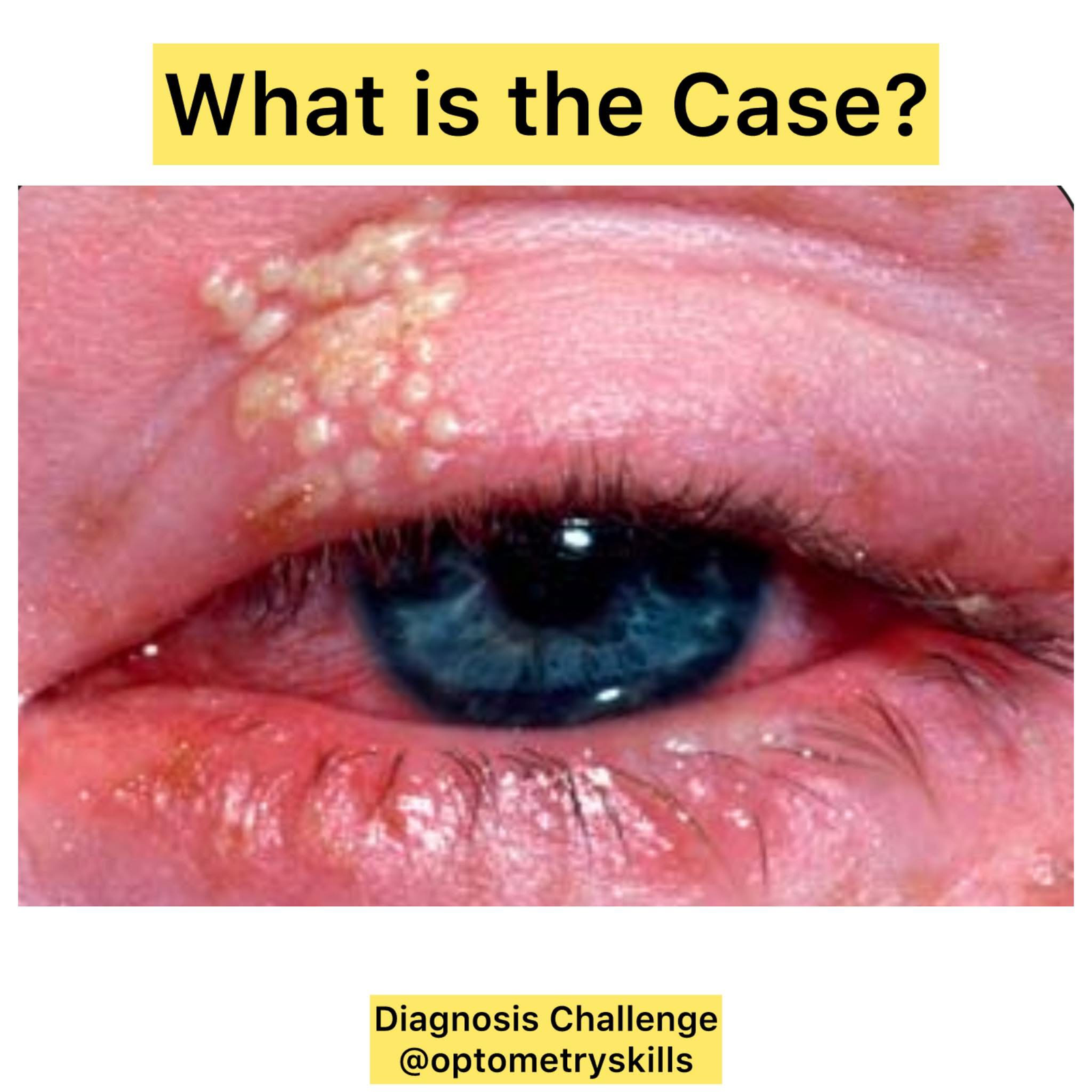 Diagnose this Eyelid Disease - Optometryskills