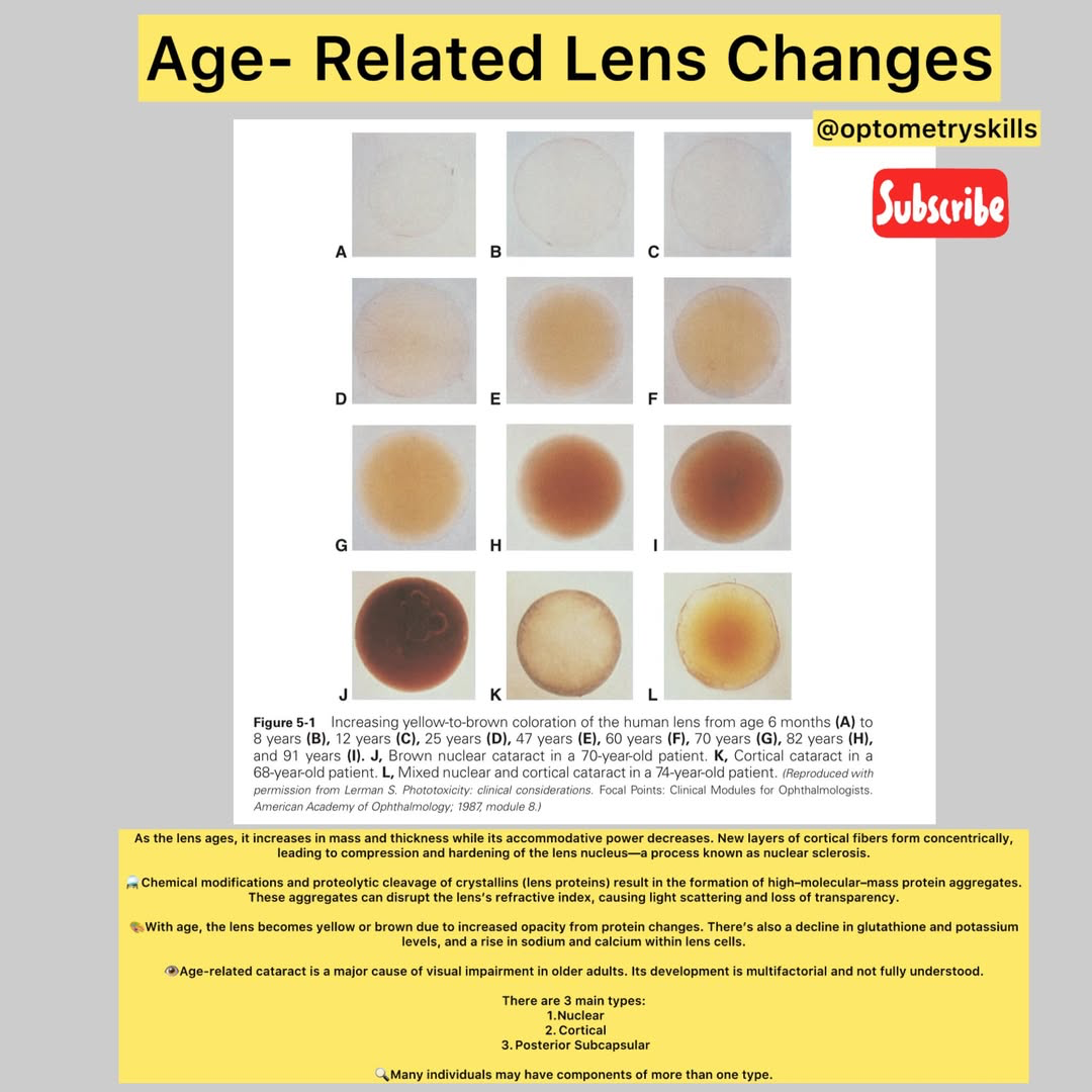 Age Related Lens changes Poster - Optometryskills