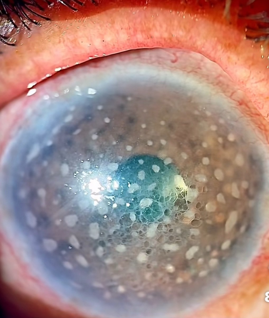 Honeycomb Corneal Epithelial Edema: Causes, Clinical Clues, and ...