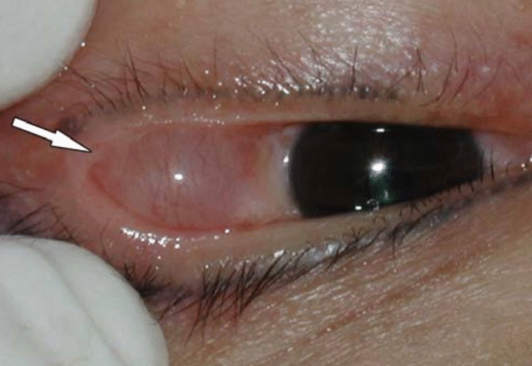 Understanding Dacryops: A Benign Eye Cyst