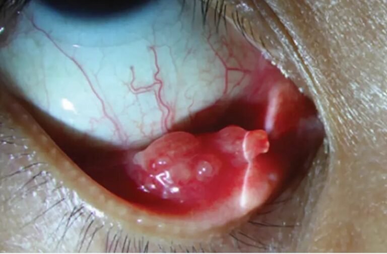 Pyogenic Granuloma of the Eyelid - Optometryskills