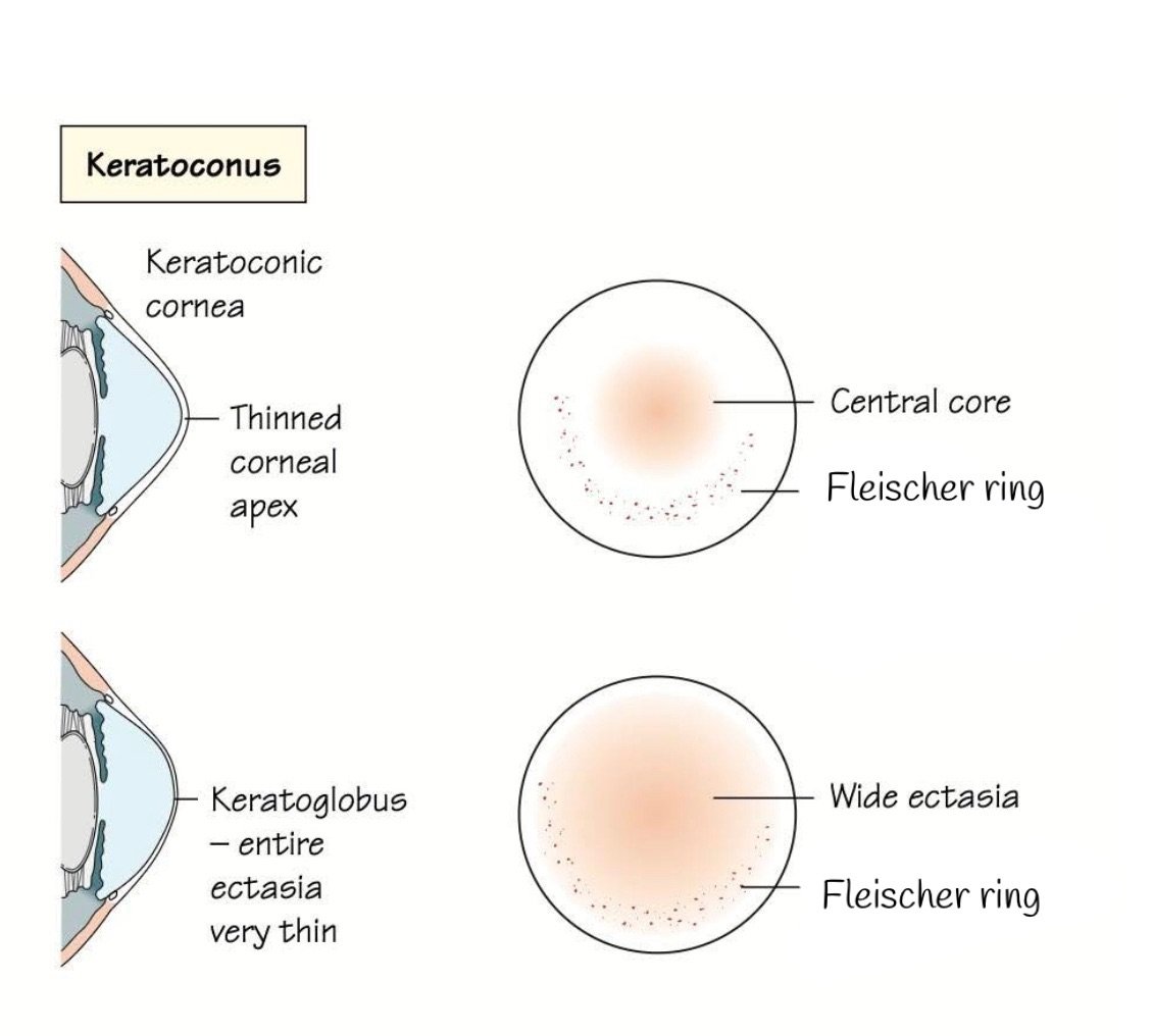 Cornea and Keratoconus - Optometryskills