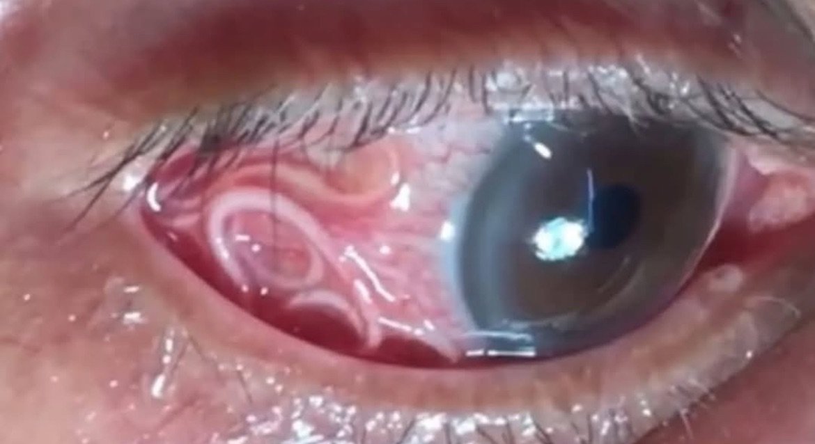 Can a Worm Live in the Human Eye? Ocular Filariasis