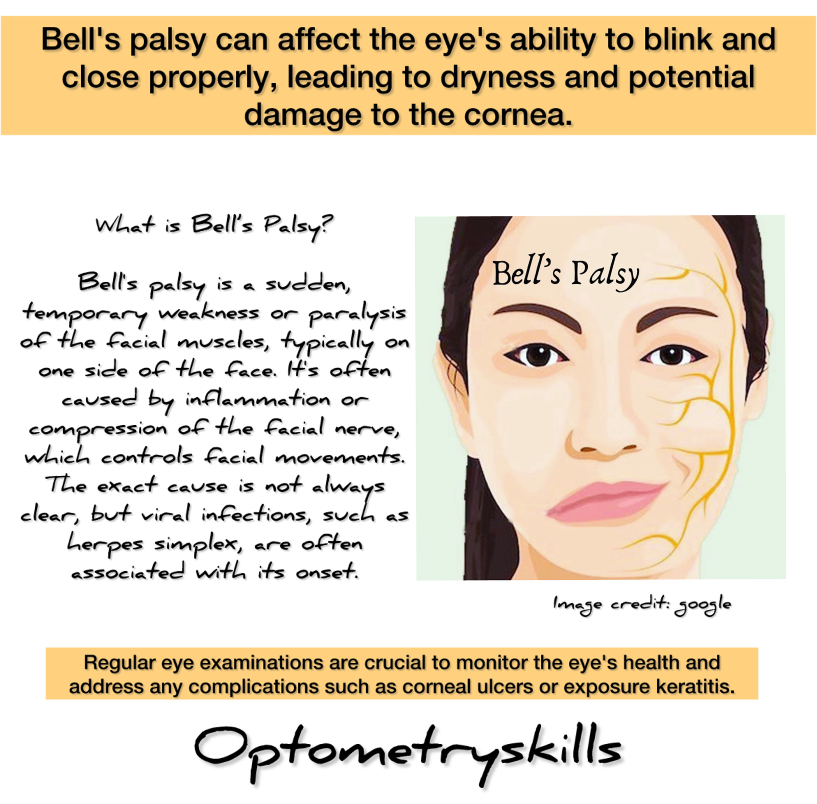 Bell's Palsy Awareness Poster: Key Information