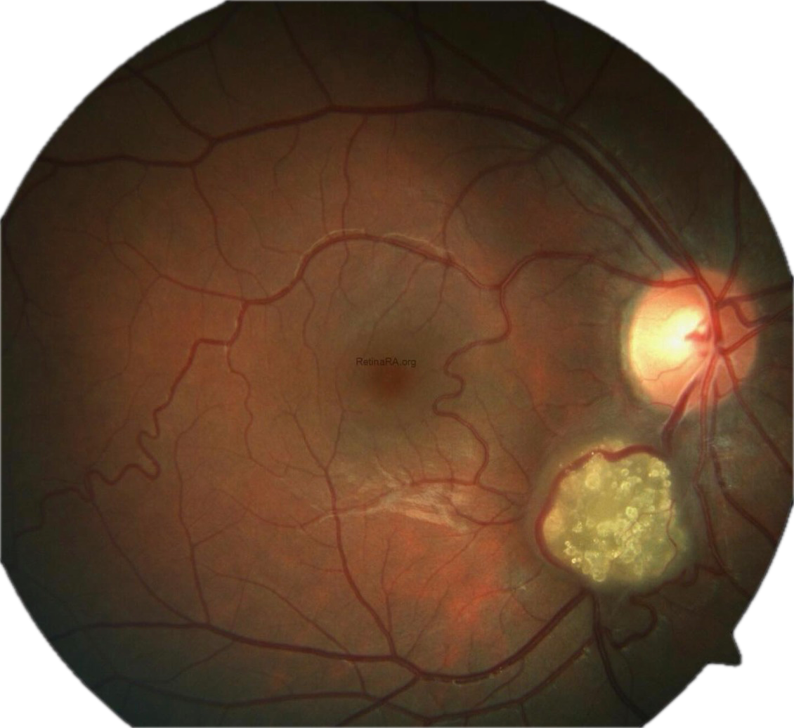 Retinal Astrocytoma (Retinal Astrocytic Hamartoma) - Optometryskills