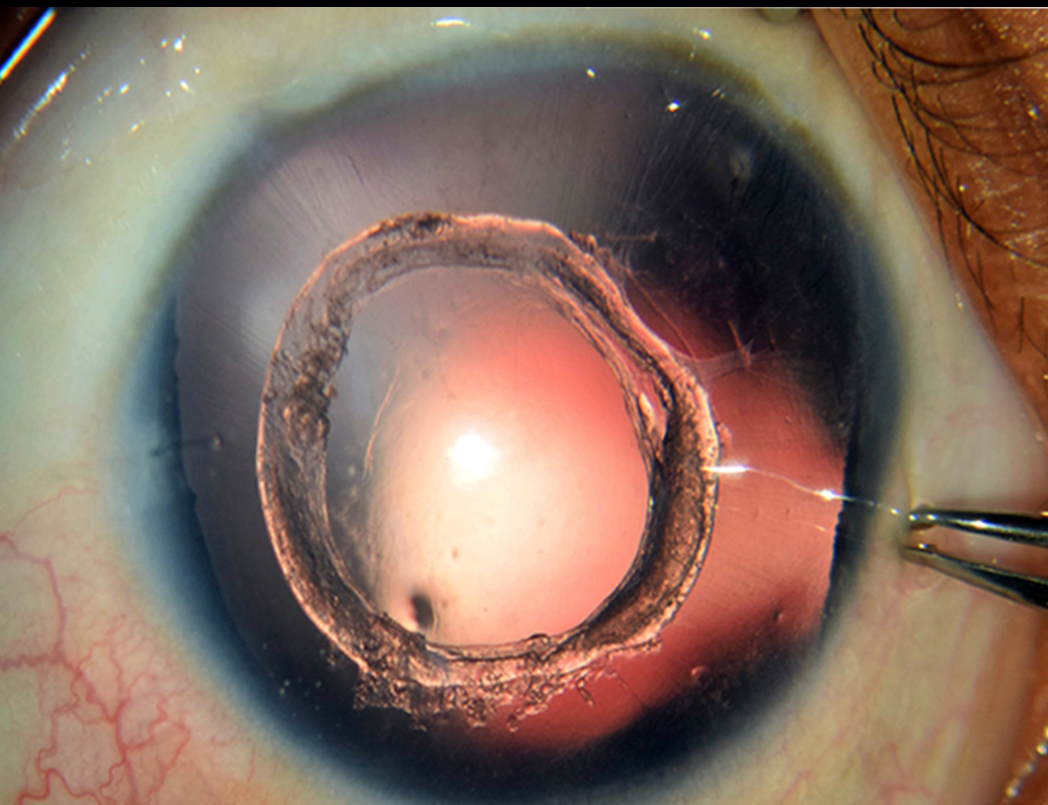 Soemmering’s Ring: Formation, Clinical Significance, and Optometric ...
