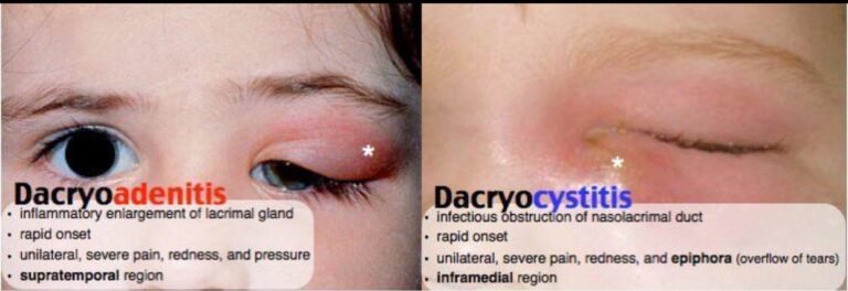 Dacryocystitis vs Dacryoadenitis: How to Differentiate Lacrimal Sac and ...