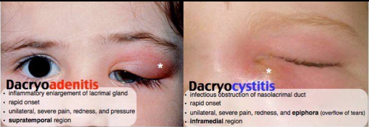 Dacryocystitis vs Dacryoadenitis: How to Differentiate Lacrimal Sac and ...