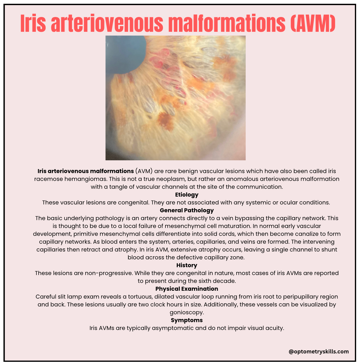 Iris Arteriovenous Malformation (AVM): Causes, Diagnosis, and ...